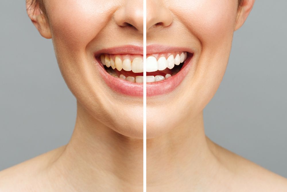 Why do teeth turn yellow? | Prospect Road Dental Surgery